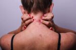 Neurodermitis Auf Kopfhaut Und Nacken - Unsere Behandlungstipps